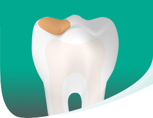 Causes of Acid Erosion | ProNamel® Toothpaste
